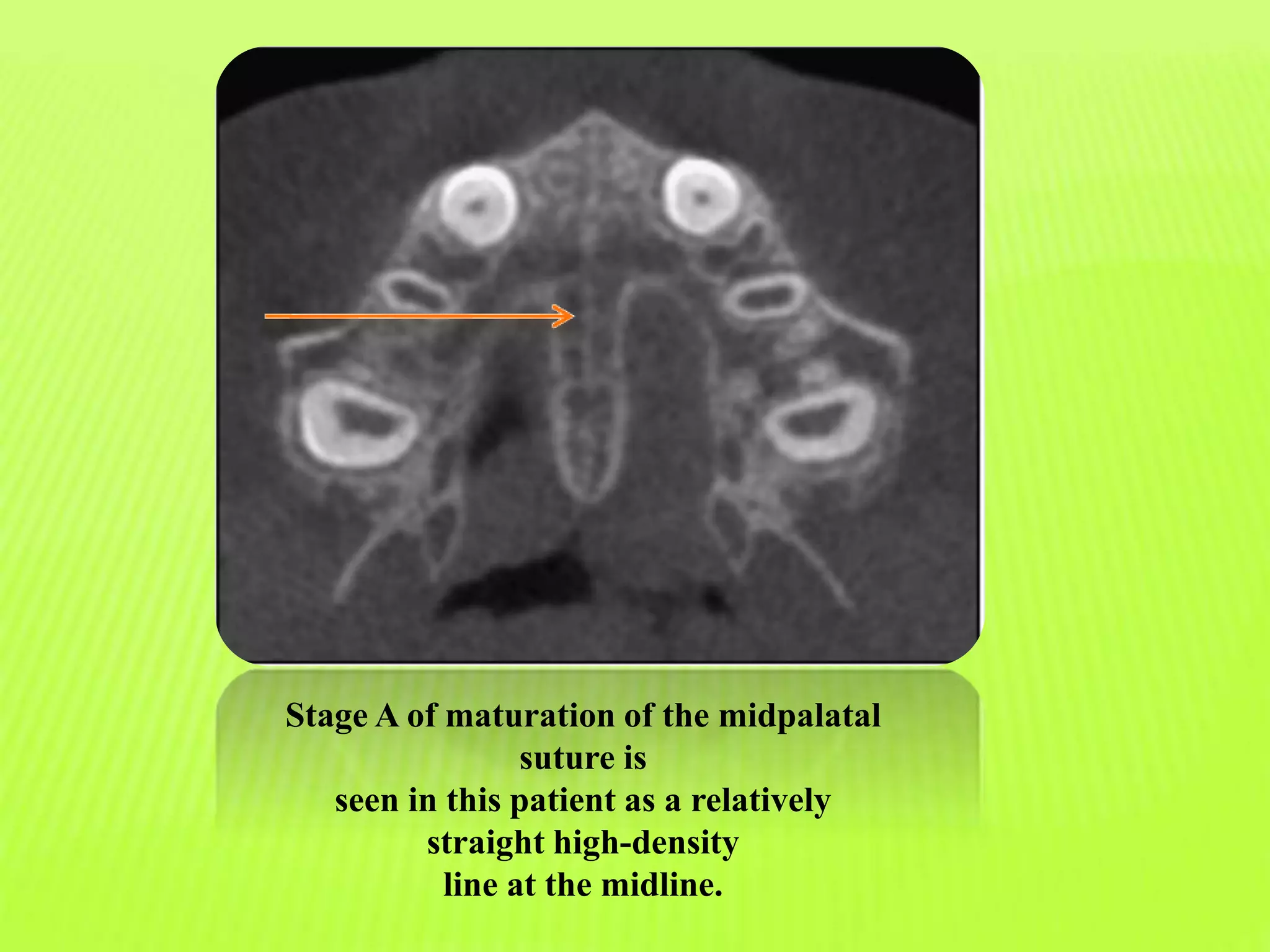 HOW to measure CBCT BEFORE AND AFTER MID PALATAL SUTURE OPENING | PPTX