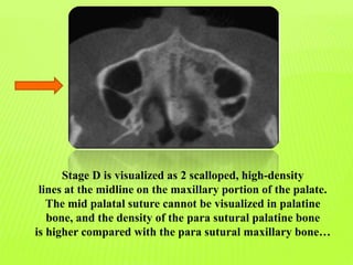 HOW to measure CBCT BEFORE AND AFTER MID PALATAL SUTURE OPENING | PPTX