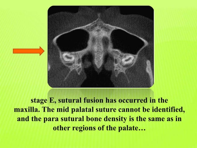 HOW to measure CBCT BEFORE AND AFTER MID PALATAL SUTURE OPENING | PPTX