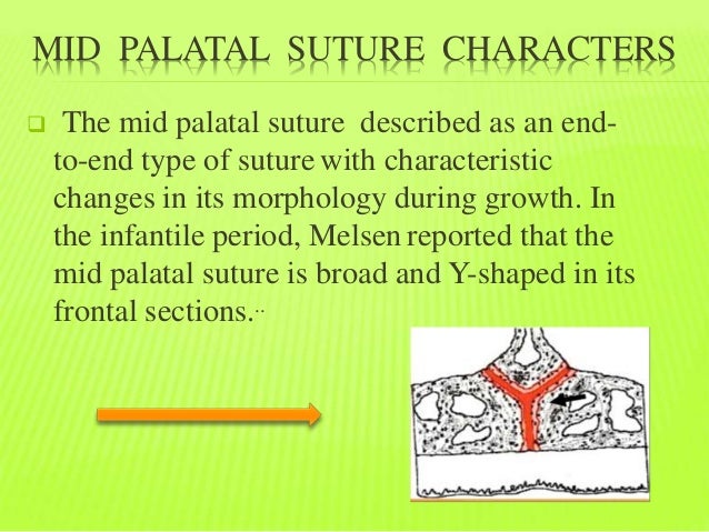 HOW to measure CBCT BEFORE AND AFTER MID PALATAL SUTURE OPEN…
