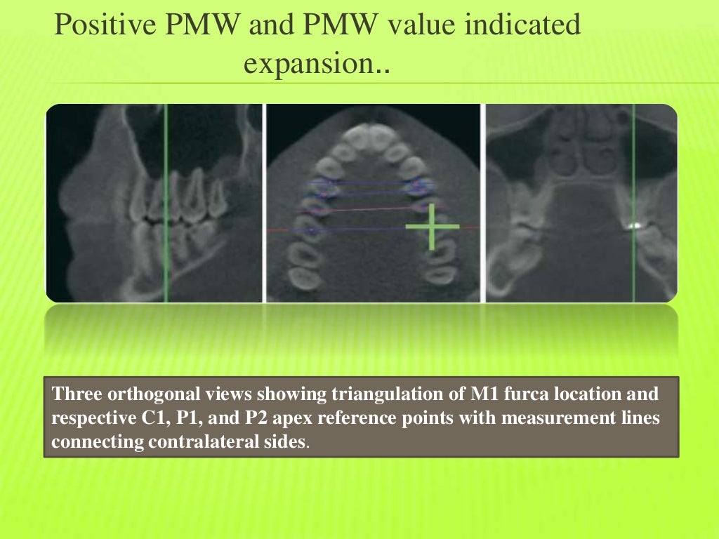 HOW to measure CBCT BEFORE AND AFTER MID PALATAL SUTURE OPEN…