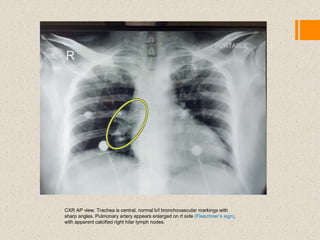 Pulmonary Embolism, Case Report of b/l PE & Literature Review | PPTX