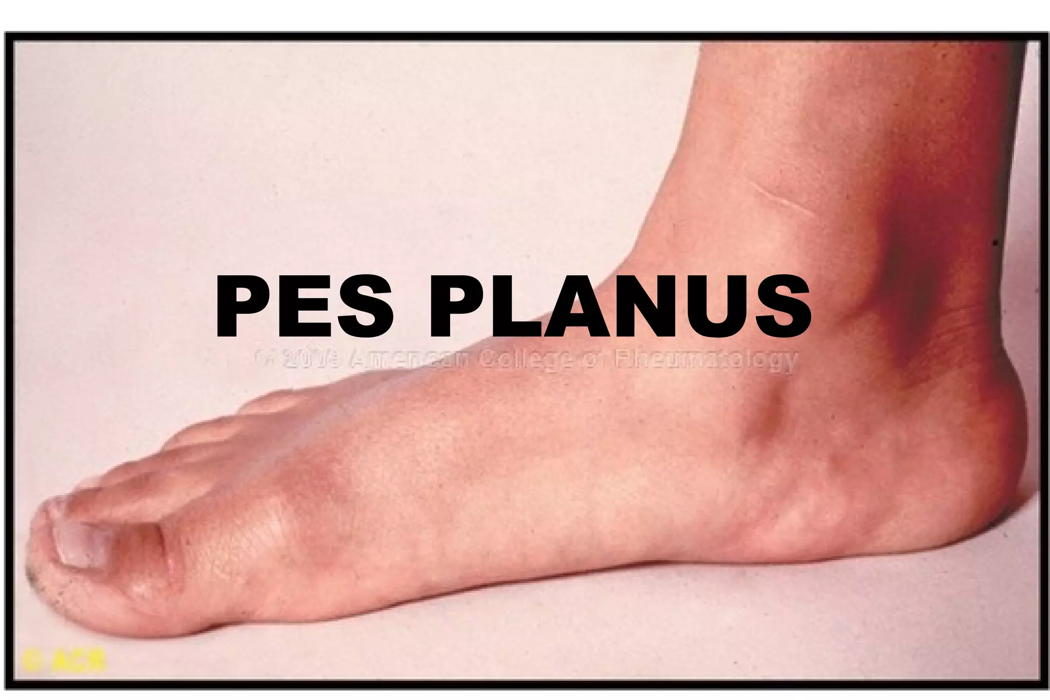 Pes planus | PPT | Death, Injury, or Military Conflict | Sensitive Topics