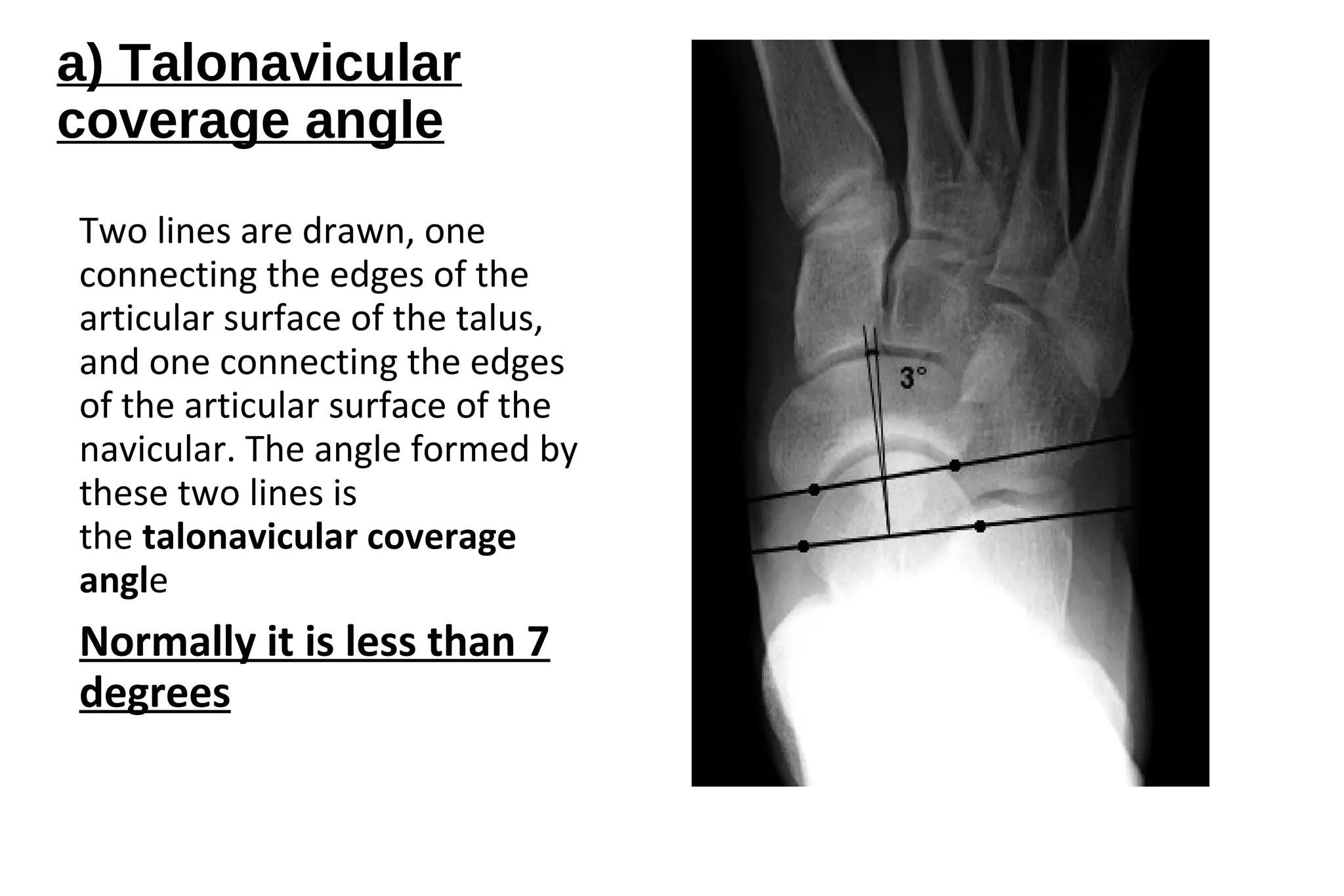 Pes planus | PPT