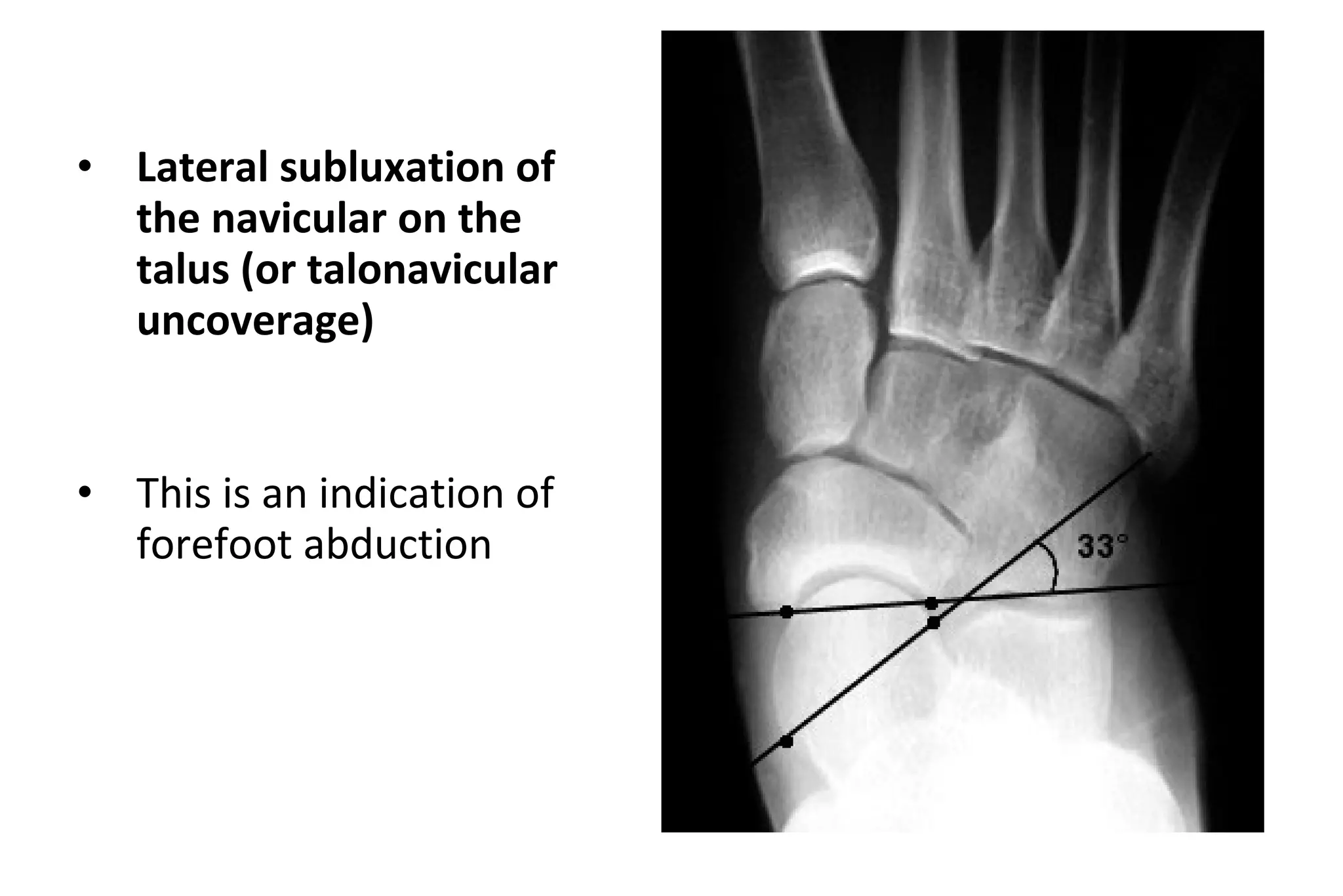 Pes planus | PPT