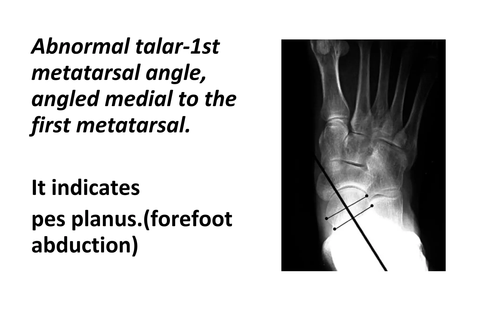 Pes planus | PPT