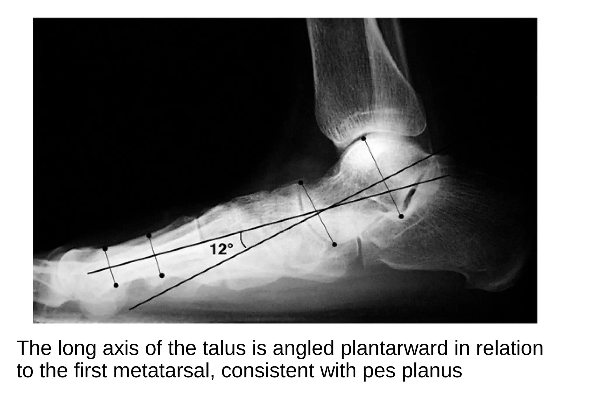 Pes planus | PPT | Death, Injury, or Military Conflict | Sensitive Topics