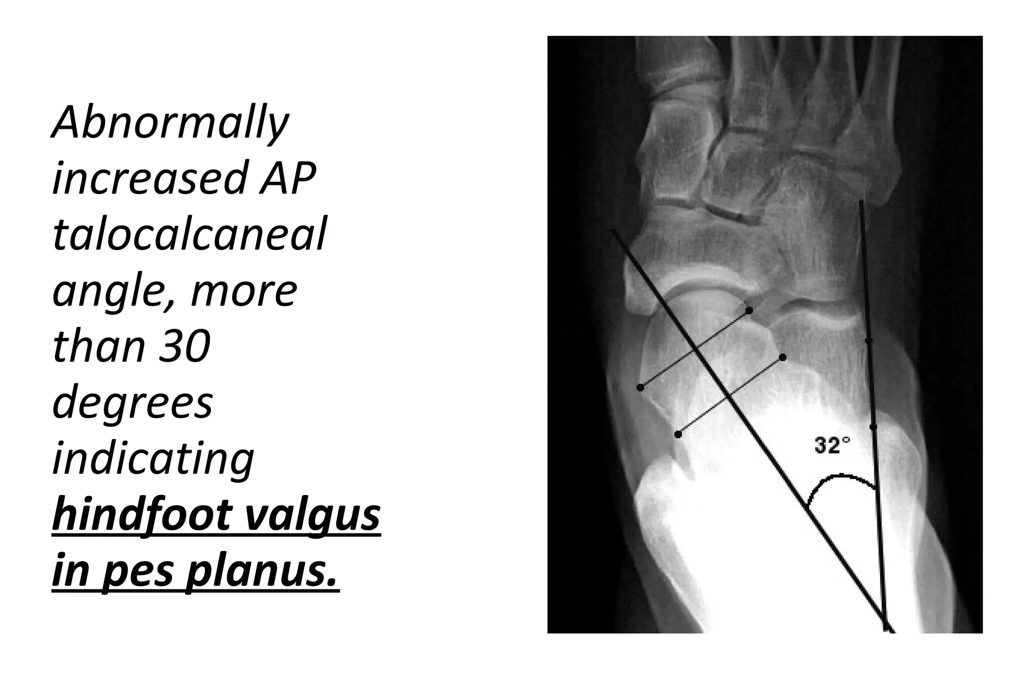 Pes planus | PPT