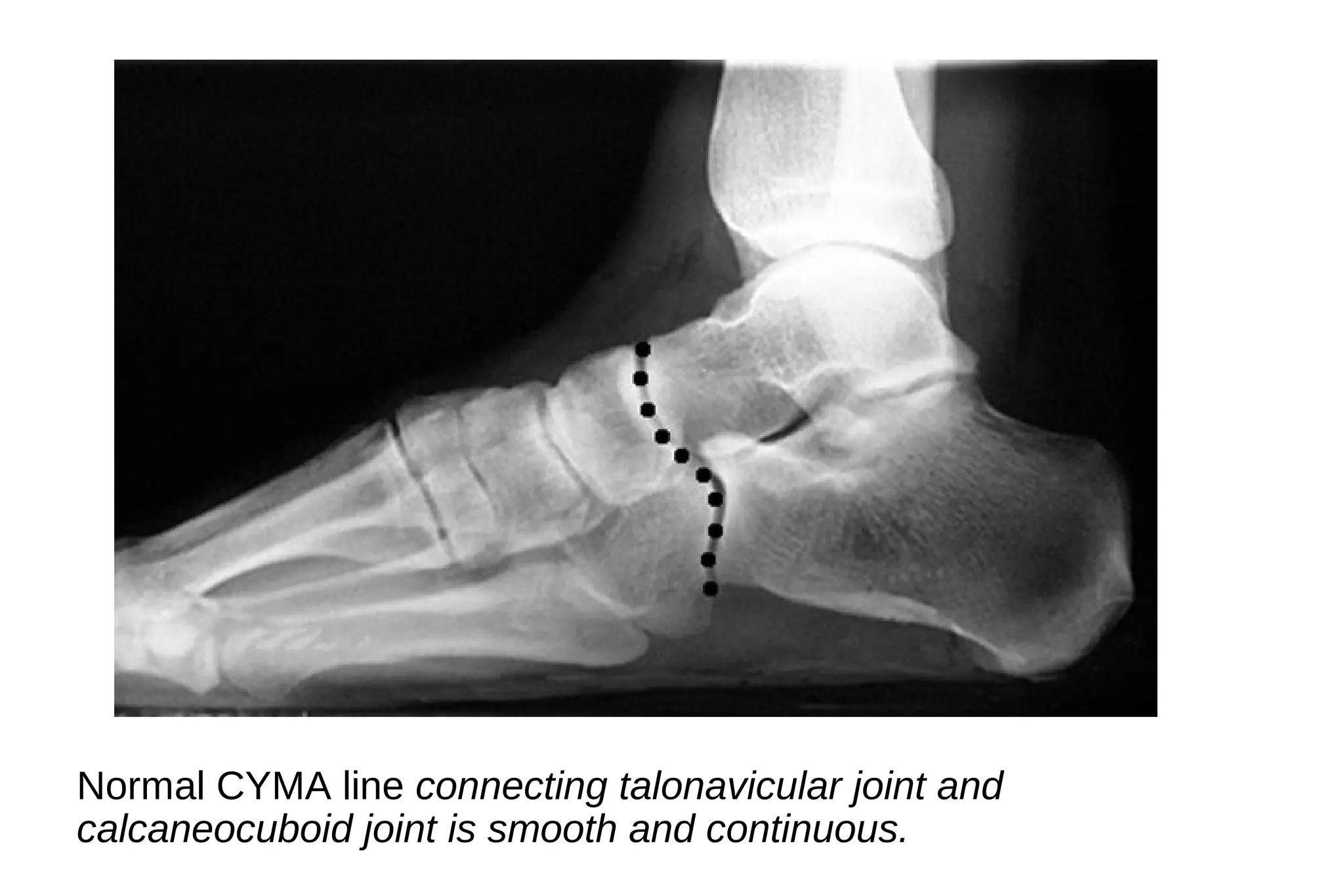 Pes planus | PPT | Death, Injury, or Military Conflict | Sensitive Topics