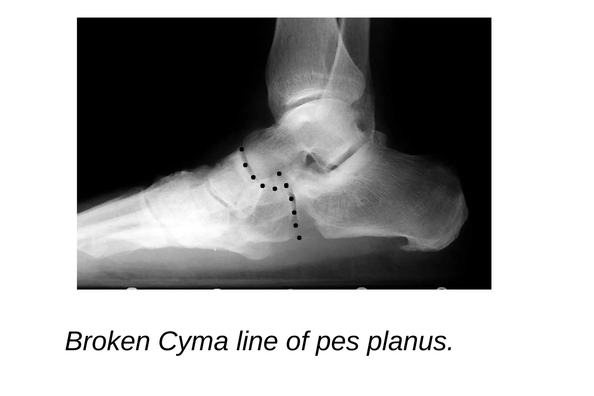 Pes planus | PPT | Death, Injury, or Military Conflict | Sensitive Topics