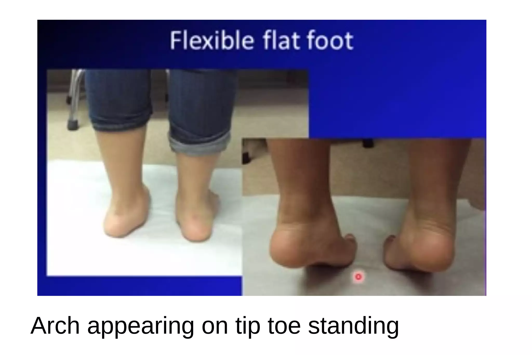 Pes planus | PPT | Death, Injury, or Military Conflict | Sensitive Topics