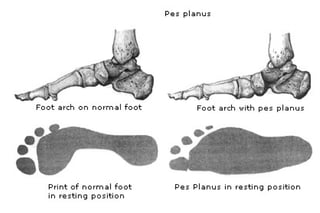 Pes planus | PPT