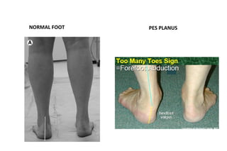 Pes planus | PPT