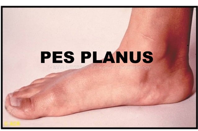 Pes Planus (Flat Foot): Causes, Symptoms, Diagnosis and Treatment | PPT