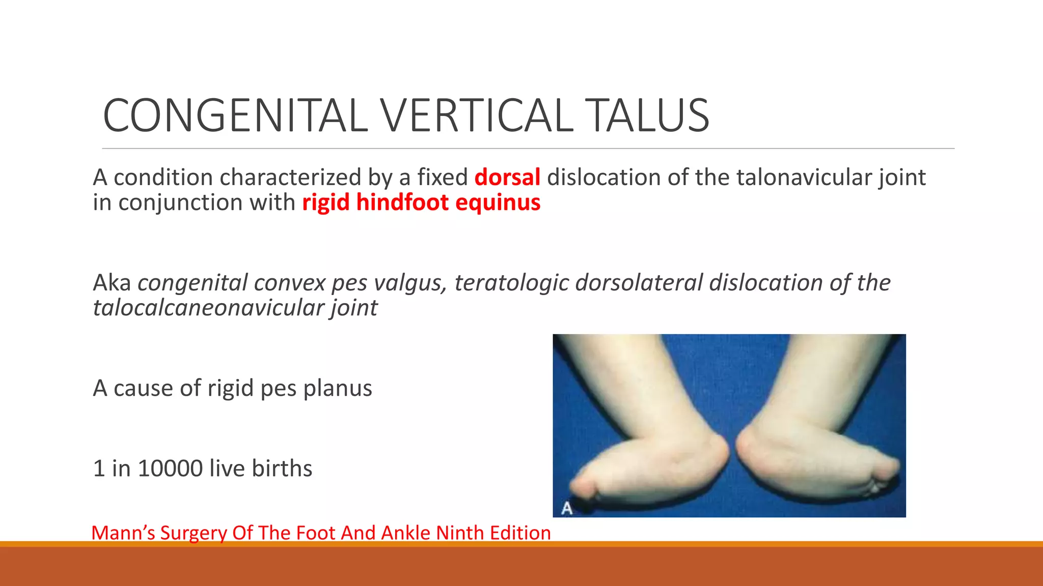 Pes planus | PPTX