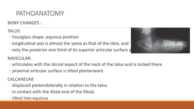 Pes planus | PPTX