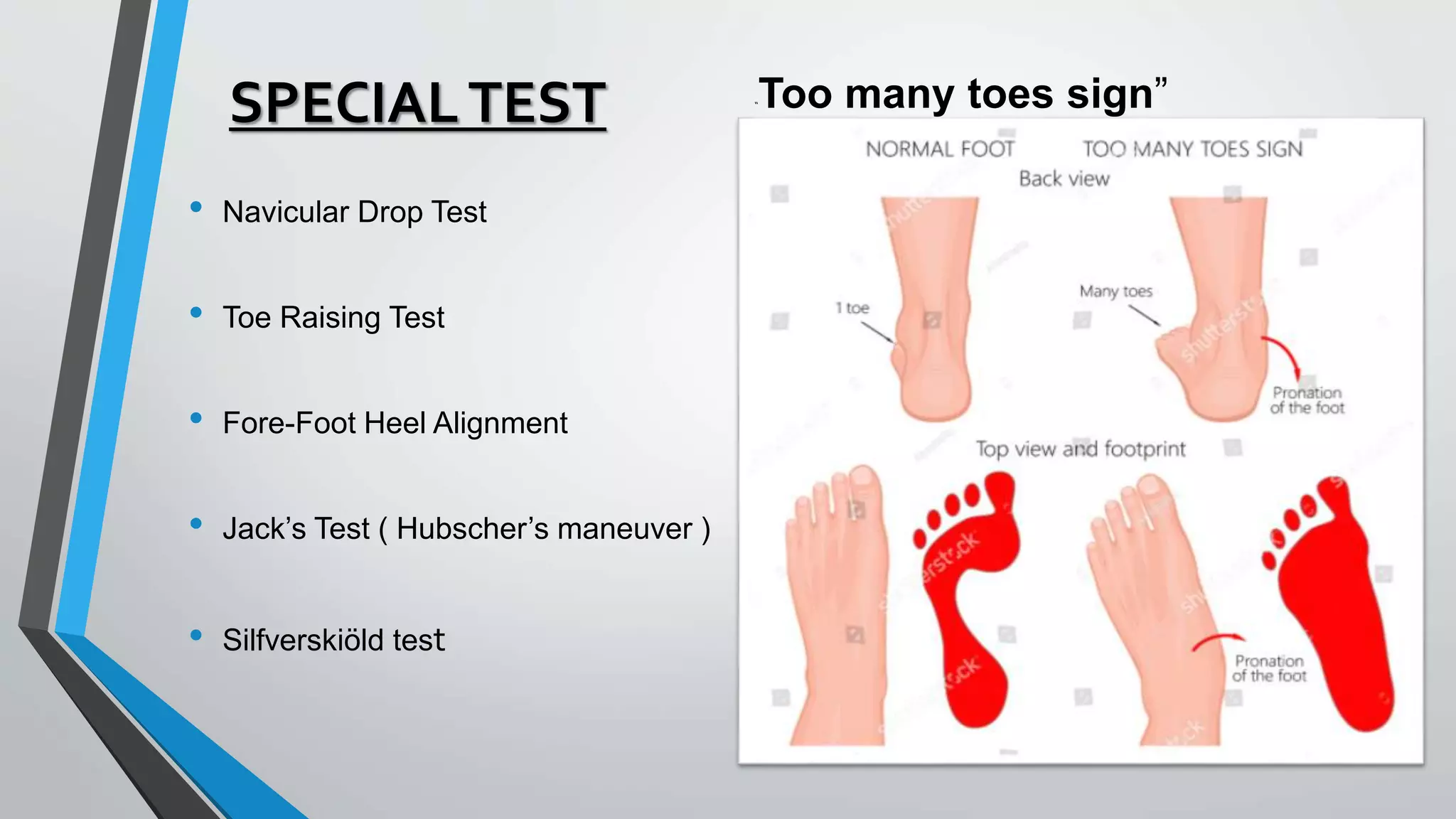 Pes planus / Flat Foot | PPTX