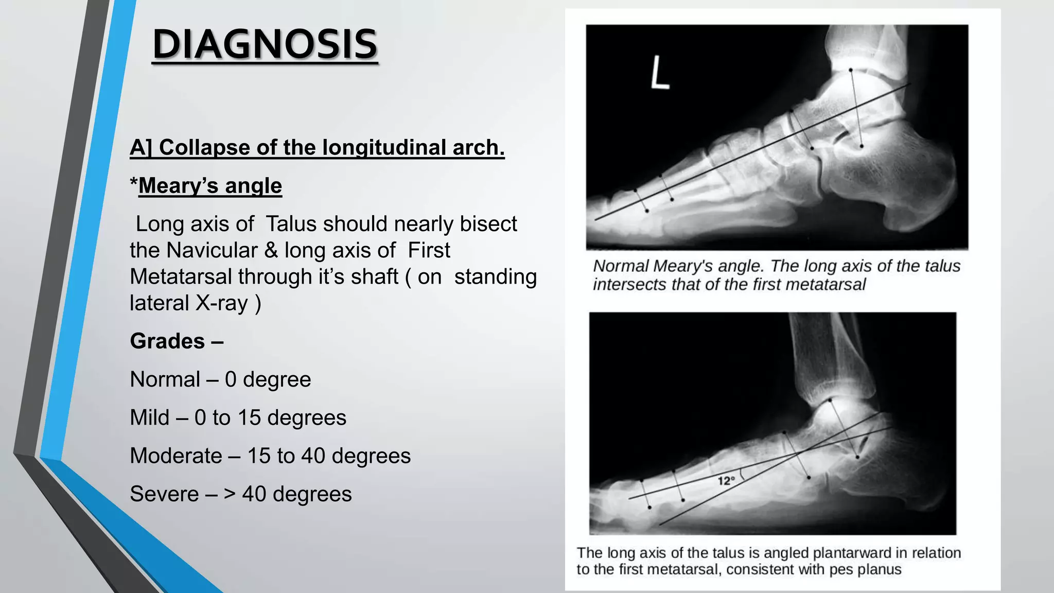Pes planus / Flat Foot | PPTX