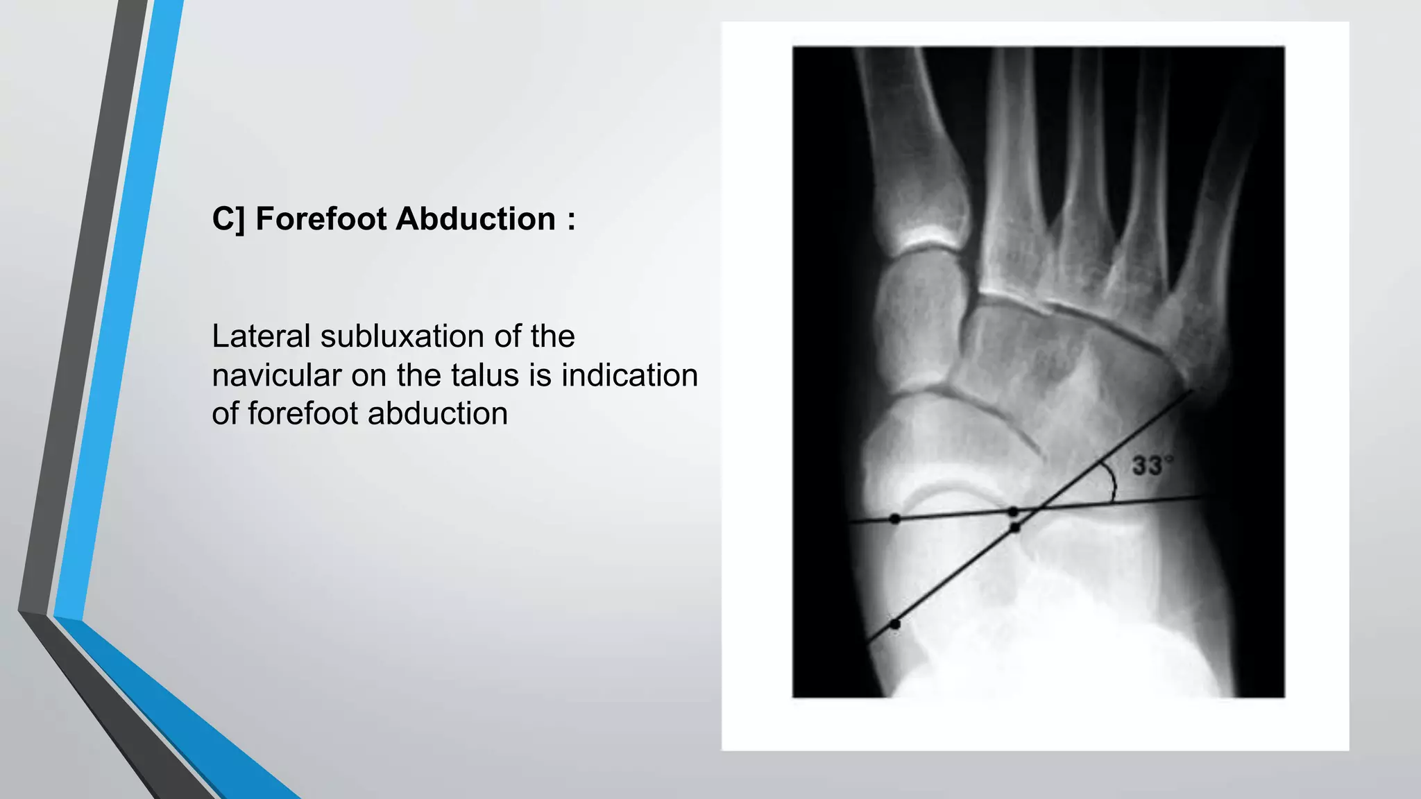Pes planus / Flat Foot | PPTX