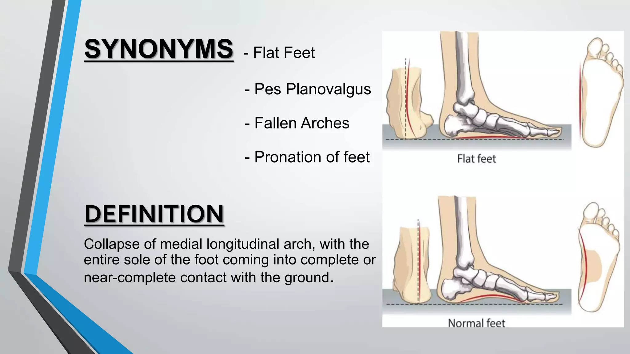 Pes planus / Flat Foot | PPTX