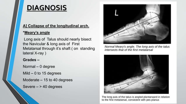 Pes planus / Flat Foot | PPTX