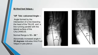Pes planus / Flat Foot | PPTX
