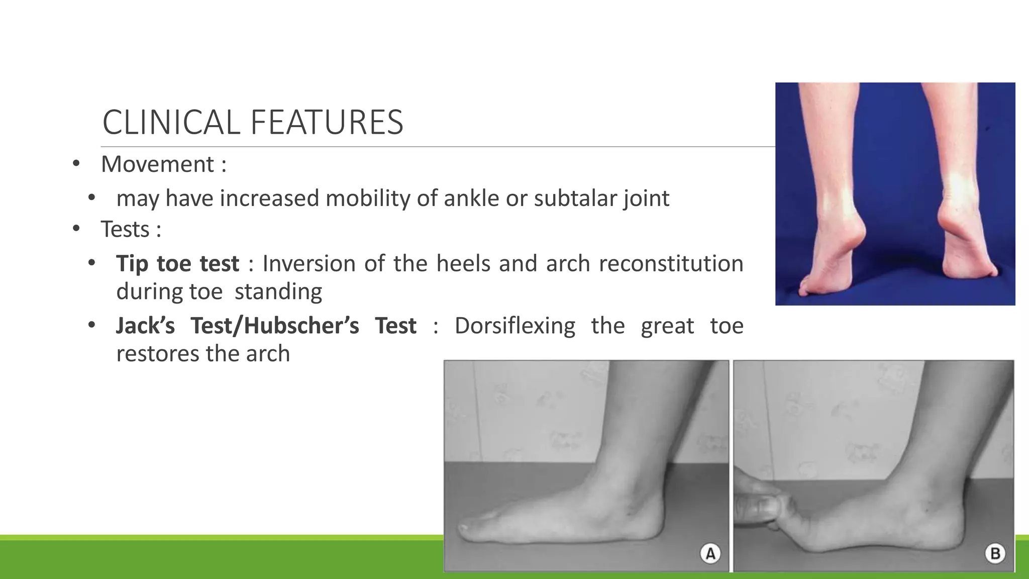 Pes planus and pes valgus | PPTX