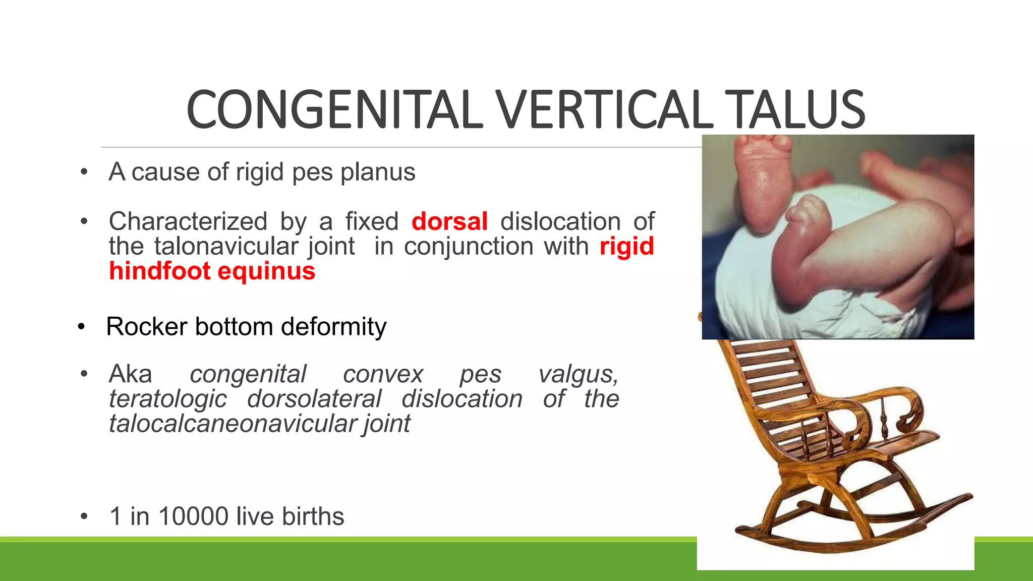 Pes planus and pes valgus | PPTX
