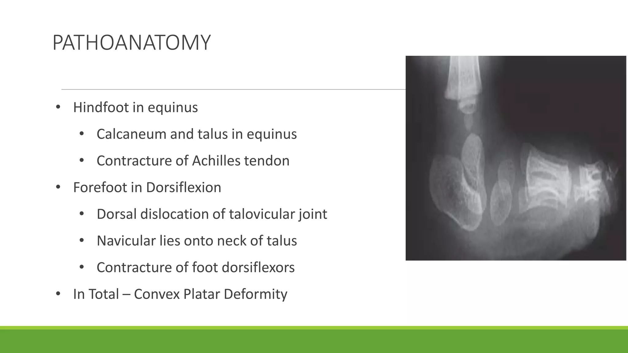 Pes planus and pes valgus | PPTX