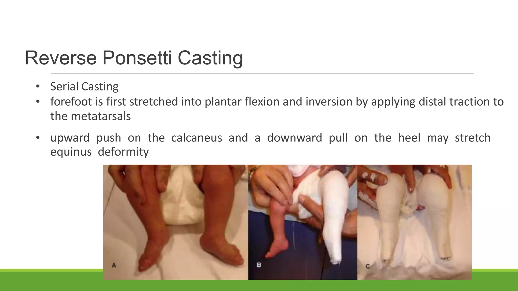 Pes planus and pes valgus | PPTX