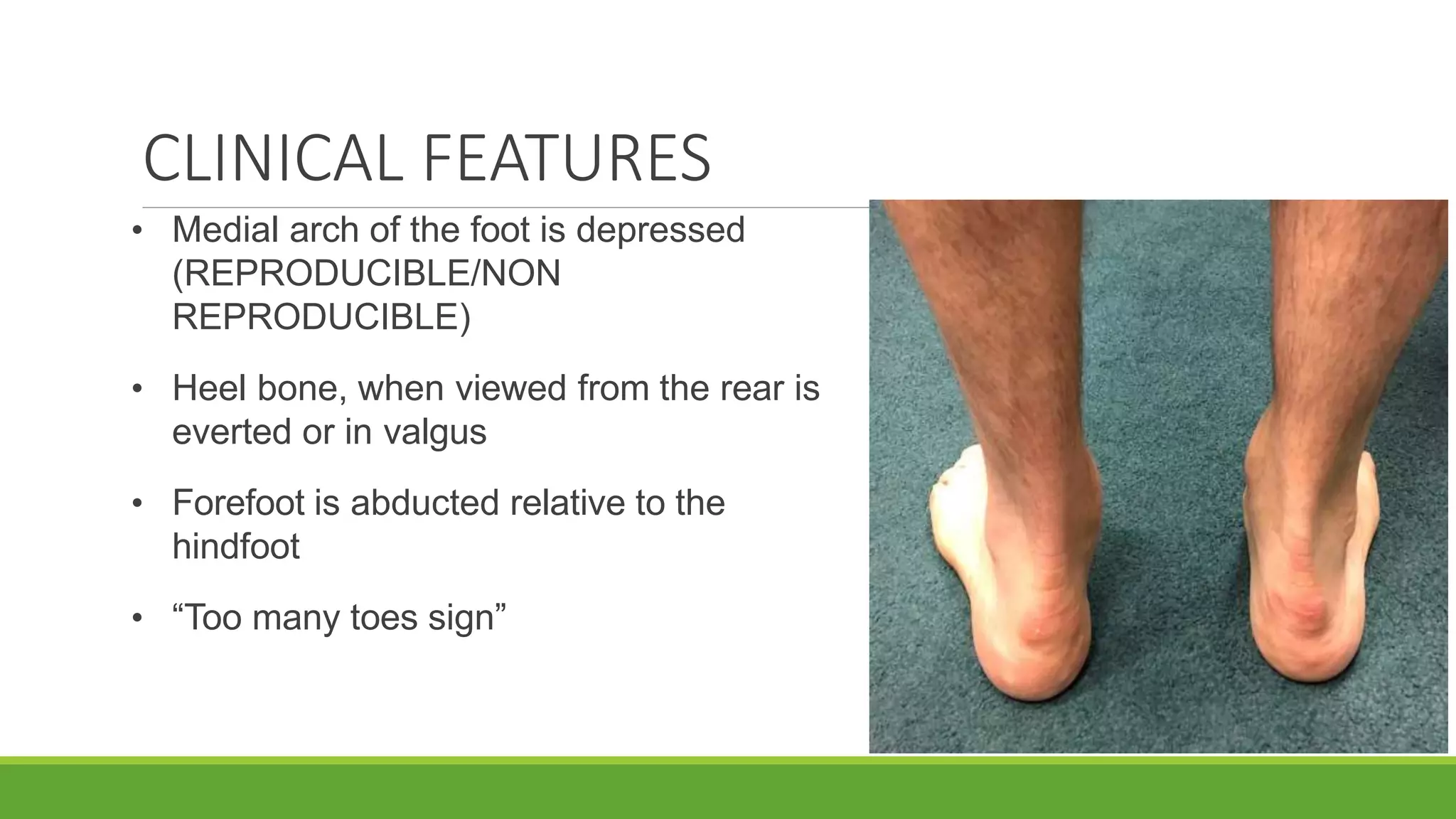 Pes planus and pes valgus | PPTX