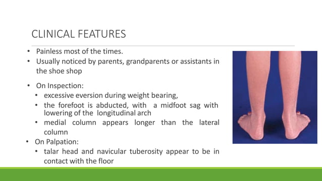 Pes planus and pes valgus | PPTX