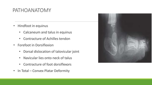 Pes planus and pes valgus | PPTX