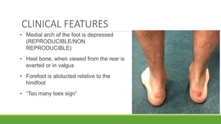 Pes planus and pes valgus | PPTX