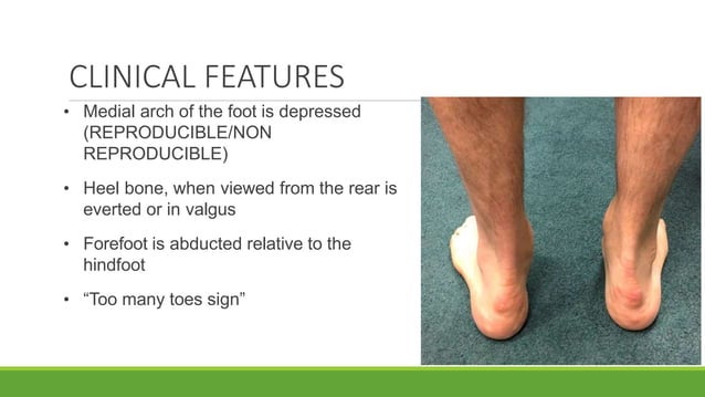 Pes planus and pes valgus | PPTX