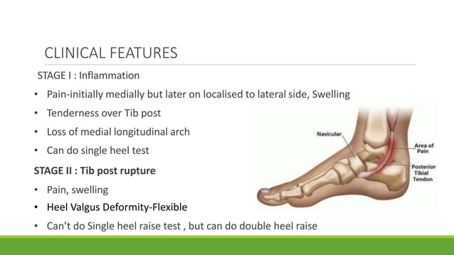 Pes planus and pes valgus | PPT