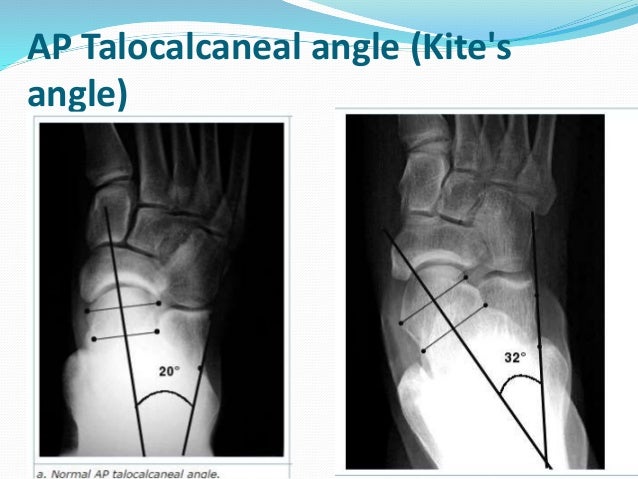 Pes plenovalgus dr zahid h malik