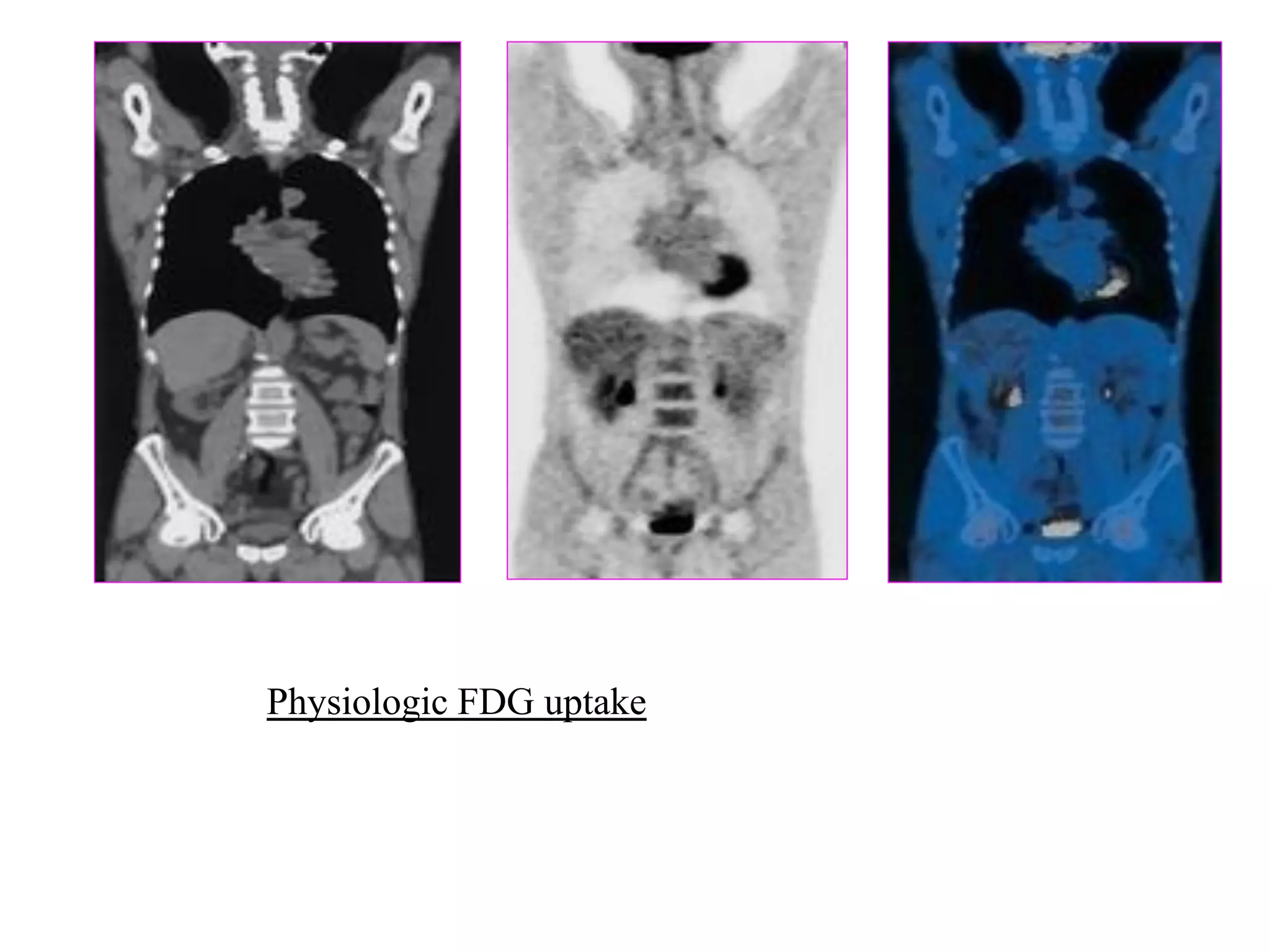 PET-CT Scan(Principles and Basics) | PDF
