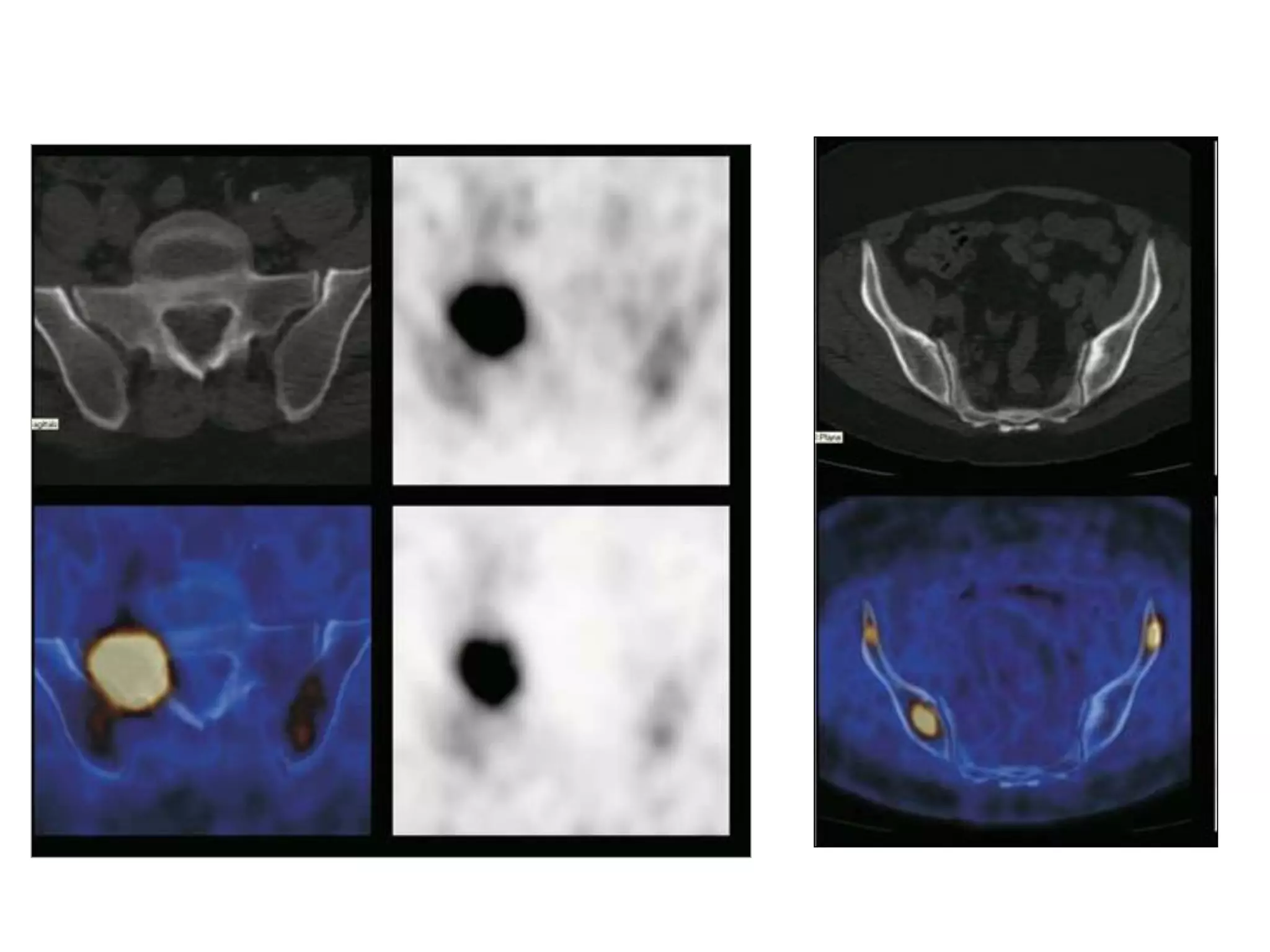 PET-CT Scan(Principles and Basics) | PDF