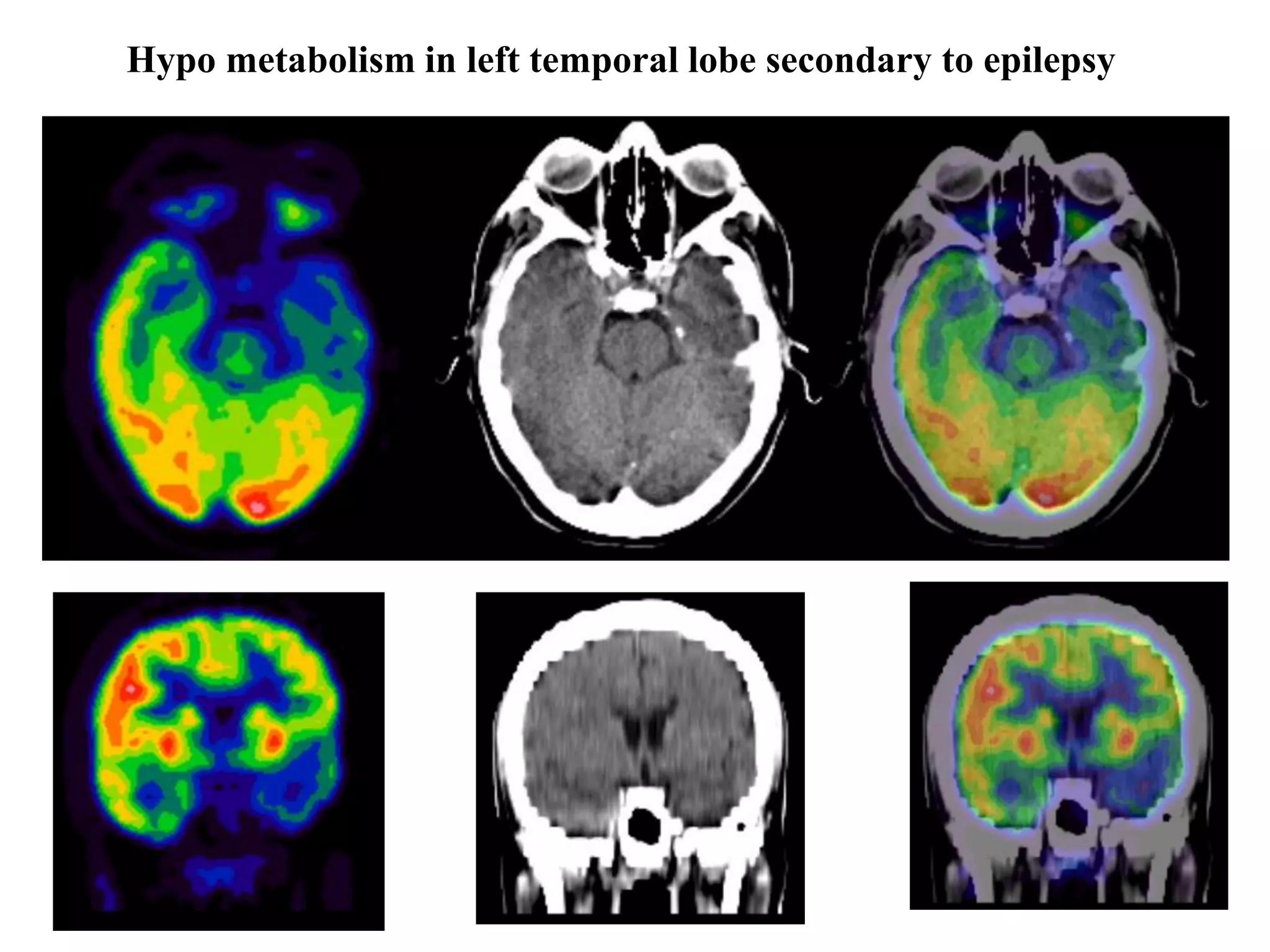 PET-CT Scan(Principles and Basics) | PDF