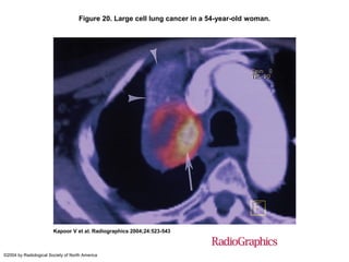 PET-CT Scan(Principles and Basics) | PDF