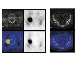 PET-CT Scan(Principles and Basics) | PDF