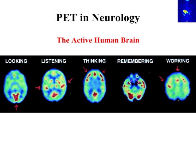 PET-CT Scan(Principles and Basics) | PDF | Lung and Respiratory Health ...
