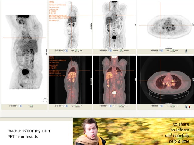 Pet Scan Results | PPT