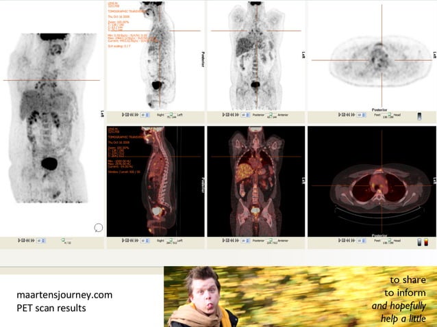 Pet Scan Results | PPT