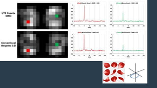 3D UTE 31P-MRSI with modified rosette k-space (PETALUTE): Comparison with conventional weighted ...