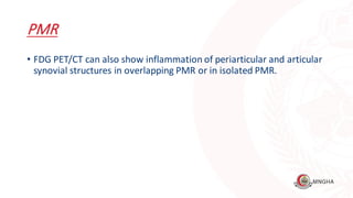 PET CT Beginners Guide part IV Covering Vasculitis and IE | PDF
