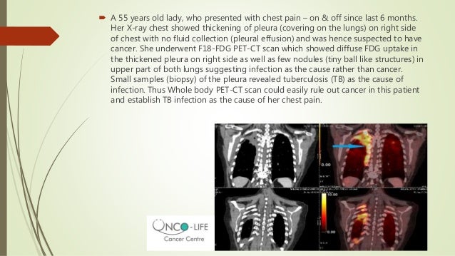 Pet CT Scan for Cancer Diagnosis - Onco Life Cancer Centre