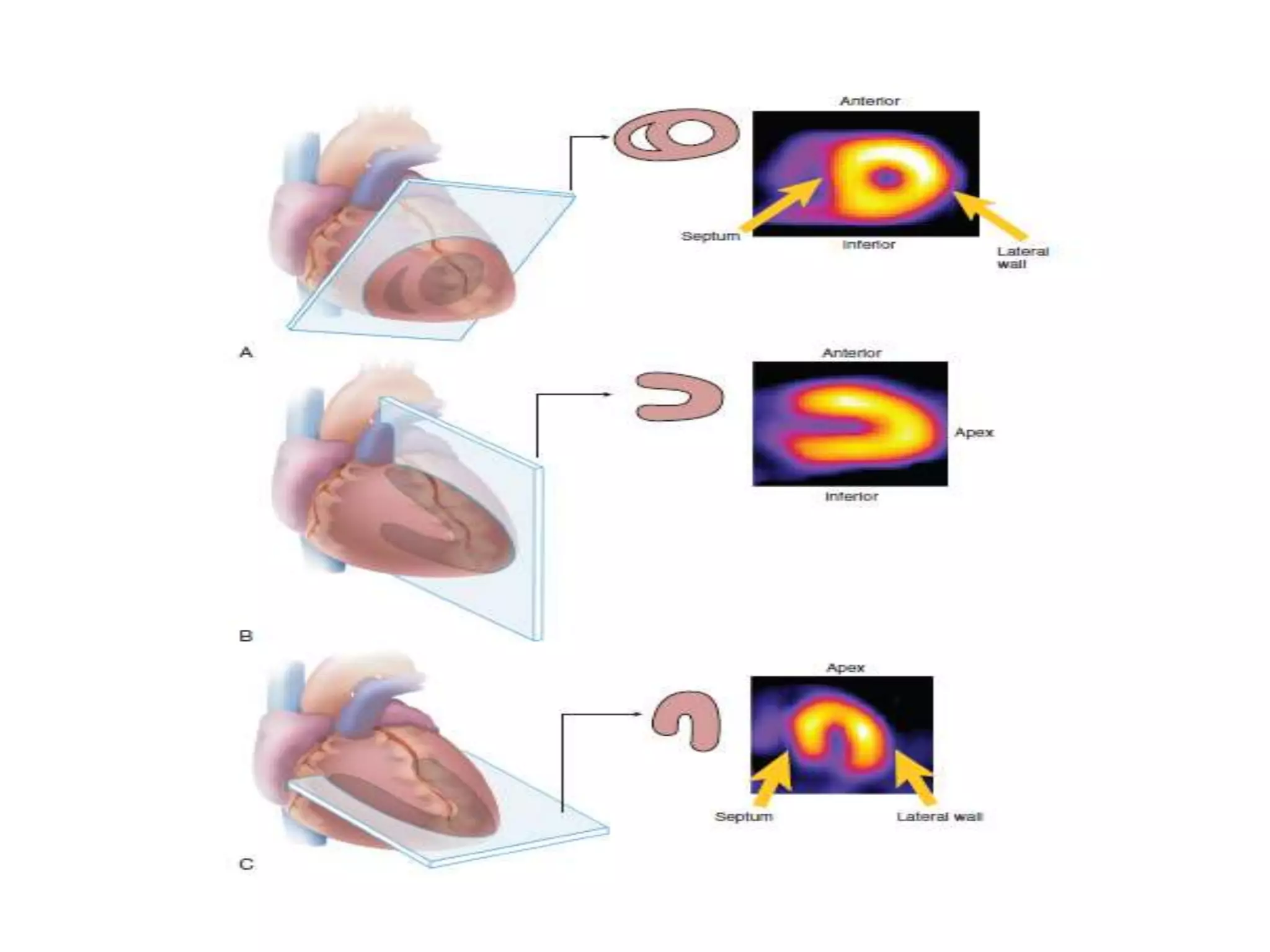 PET scan in Cardilogy | PPTX