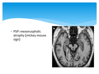 PET/MR imaging in neurodegenerative diseases | PPTX